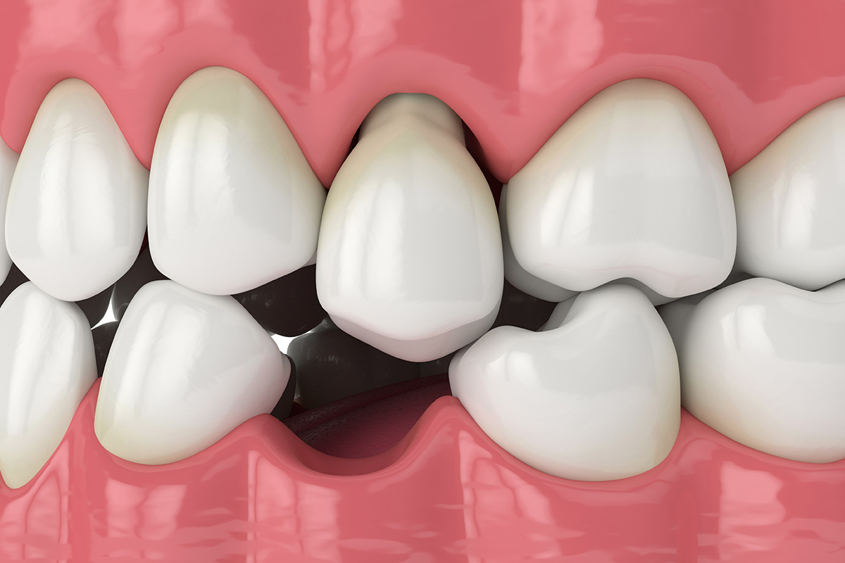 Confidence Starts with a Complete Smile – Replace Your Missing Tooth ...